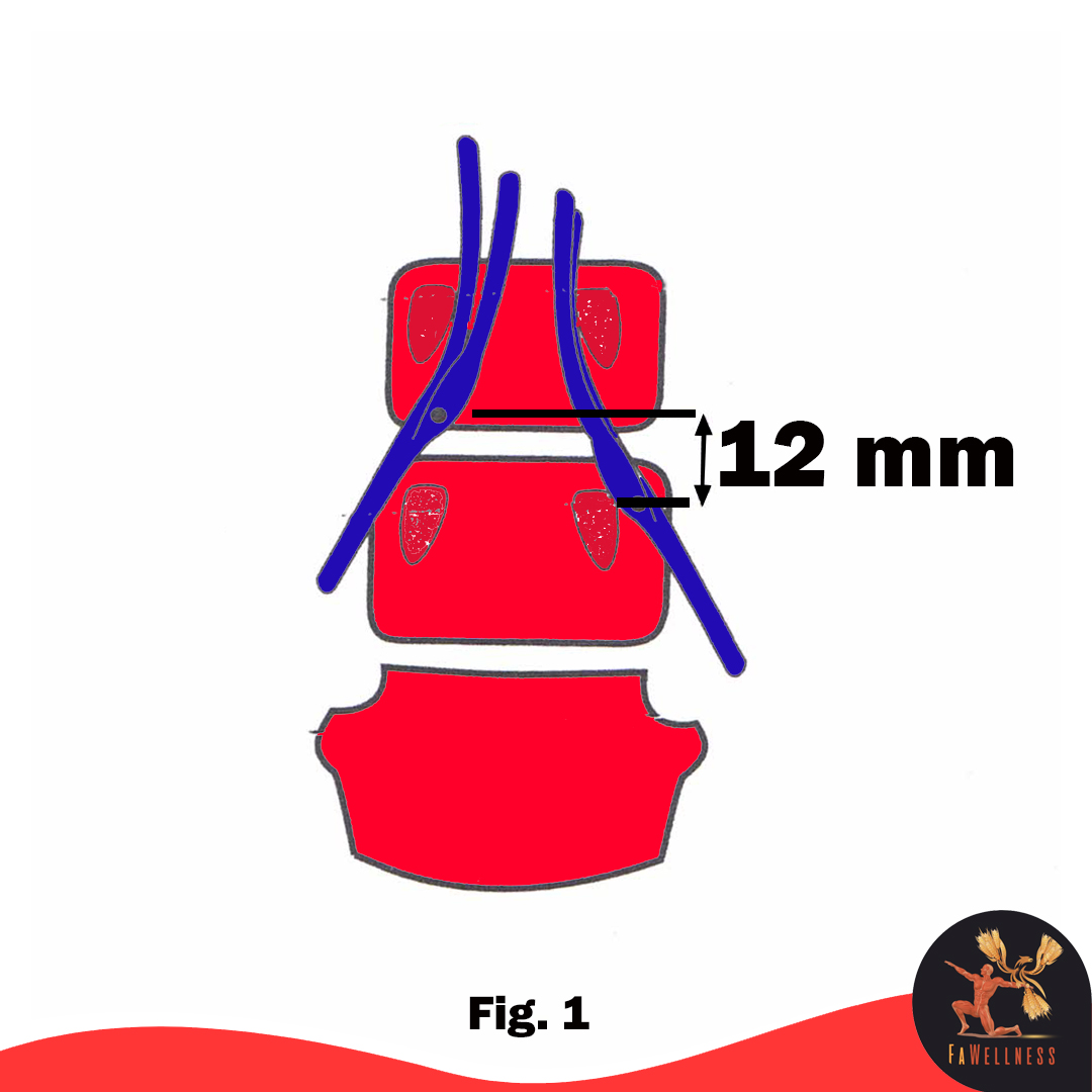 Saber del signo de Laségue te puede ayudar con tus dolores de espalda